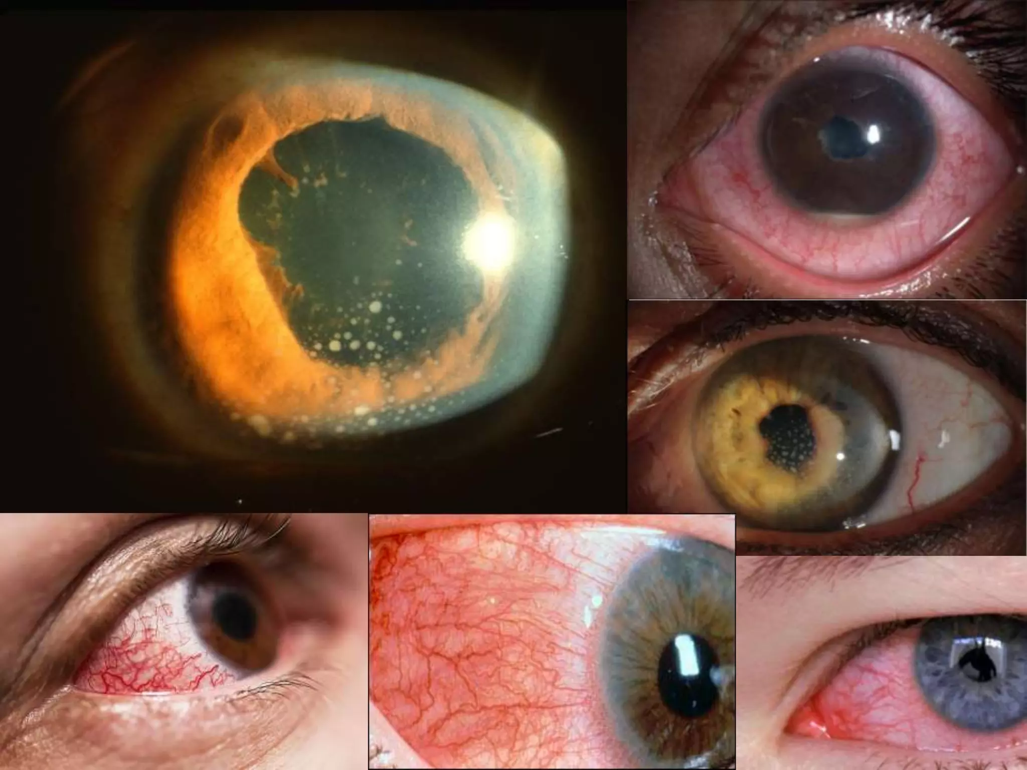 Extraintestinal Manifestations OF IBD Inflammatory Bowel Disease : A ...