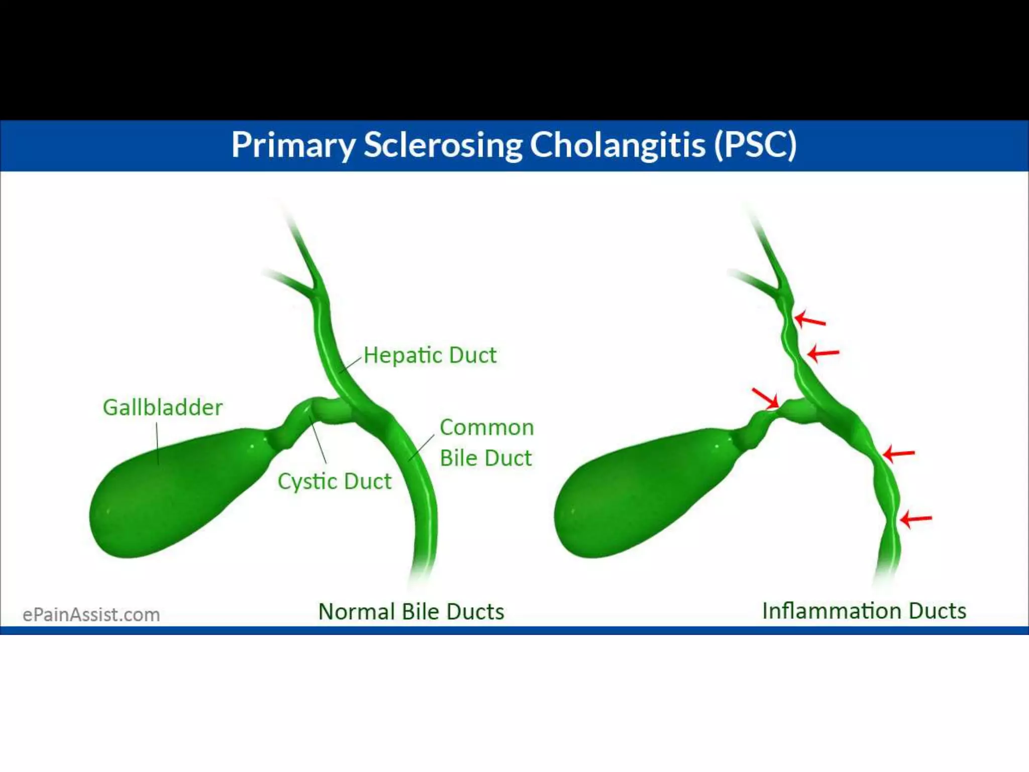Extraintestinal Manifestations OF IBD Inflammatory Bowel Disease : A ...