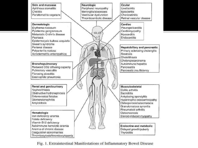 Extraintestinal Manifestations OF IBD Inflammatory Bowel Disease : A ...