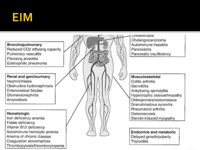 Extraintestinal Manifestations OF IBD Inflammatory Bowel Disease : A ...