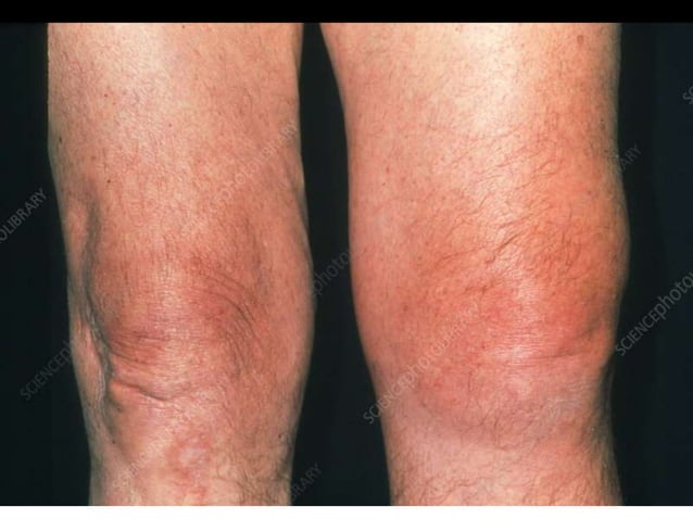Extraintestinal Manifestations OF IBD Inflammatory Bowel Disease : A ...