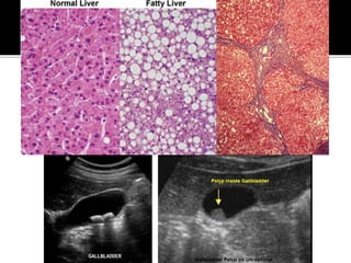 Extraintestinal Manifestations OF IBD Inflammatory Bowel Disease : A ...