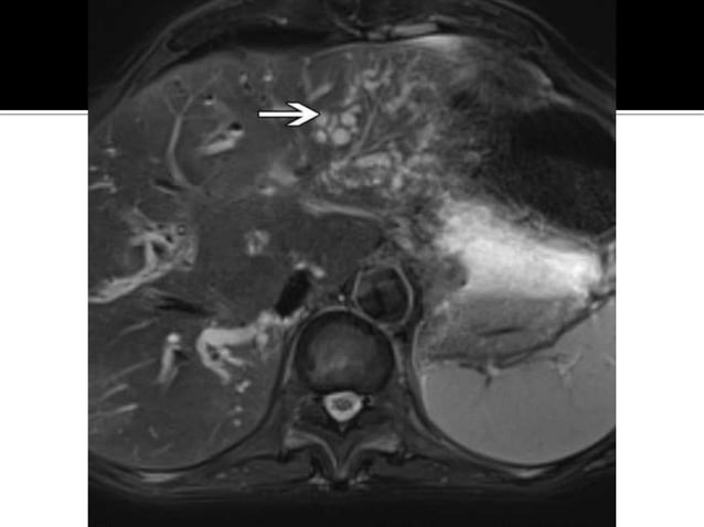 Extraintestinal Manifestations OF IBD Inflammatory Bowel Disease : A ...