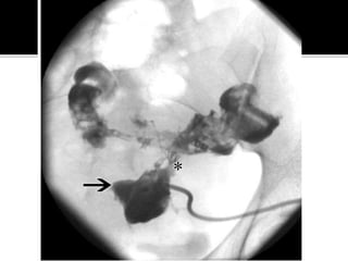 Extraintestinal Manifestations OF IBD Inflammatory Bowel Disease : A ...
