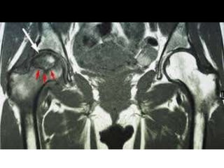 Extraintestinal Manifestations OF IBD Inflammatory Bowel Disease : A ...