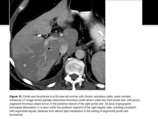 Extraintestinal Manifestations OF IBD Inflammatory Bowel Disease : A ...