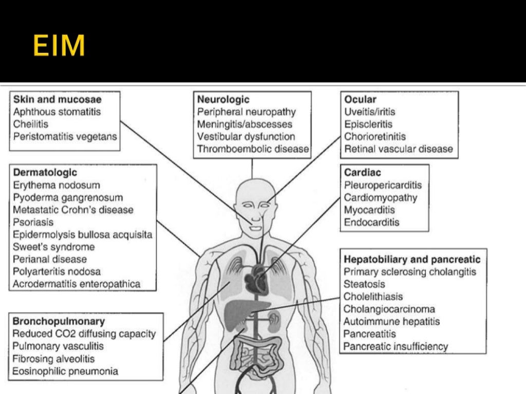 Extraintestinal Manifestations OF IBD Inflammatory Bowel Disease : A…