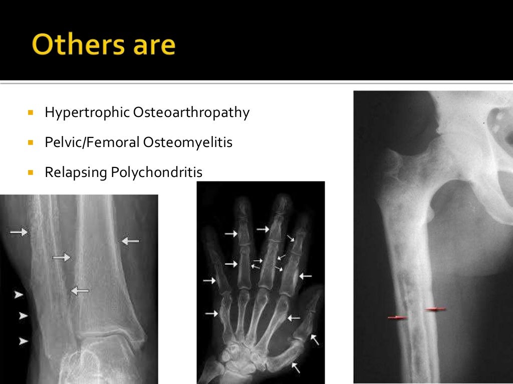 Extraintestinal Manifestations OF IBD Inflammatory Bowel Disease : A…