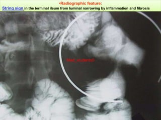 Inflammatory bowel disease | PPTX | Digestive Disorders | Diseases and ...