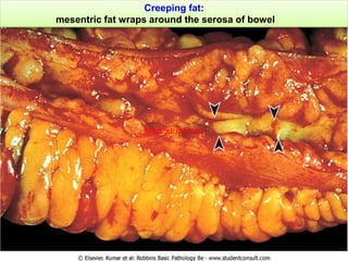 Inflammatory bowel disease | PPTX | Digestive Disorders | Diseases and ...