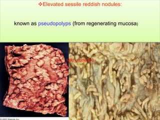 Inflammatory bowel disease | PPTX