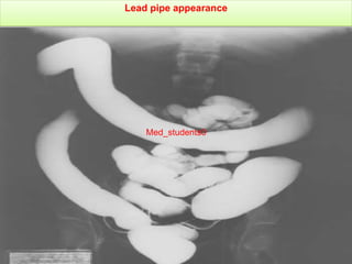 Inflammatory bowel disease | PPTX | Digestive Disorders | Diseases and ...