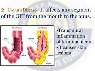 Inflammatory Bowel Disease | PPTX