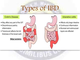 Inflammatory Bowel Disease | PPT