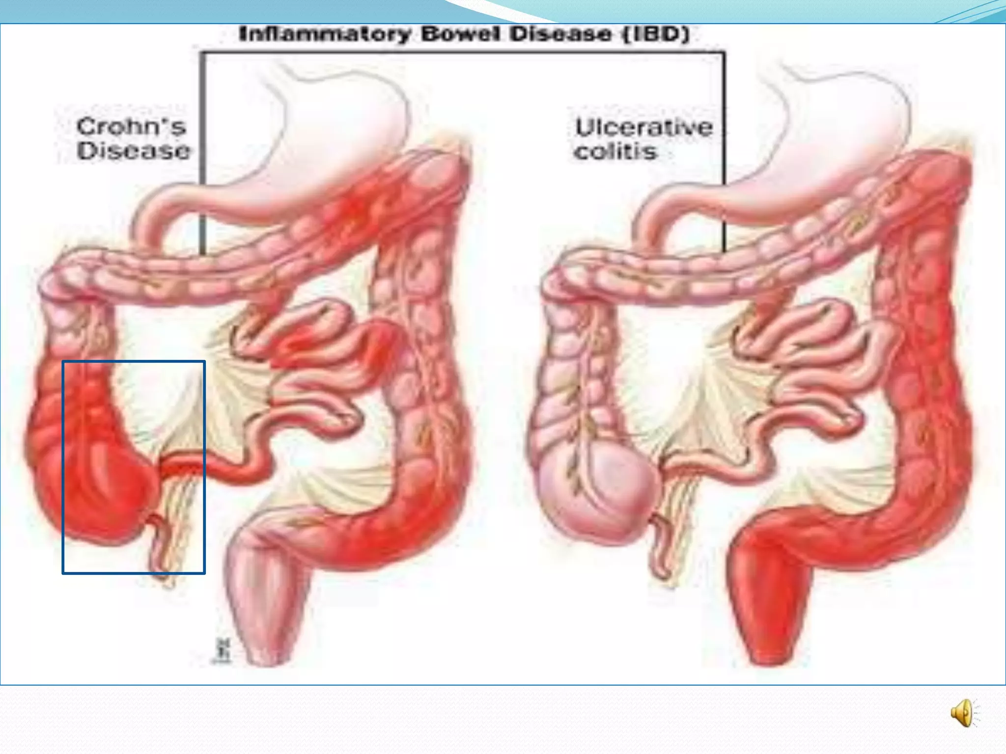 Ibd ulcerative colitis and crohn's disease | PPTX