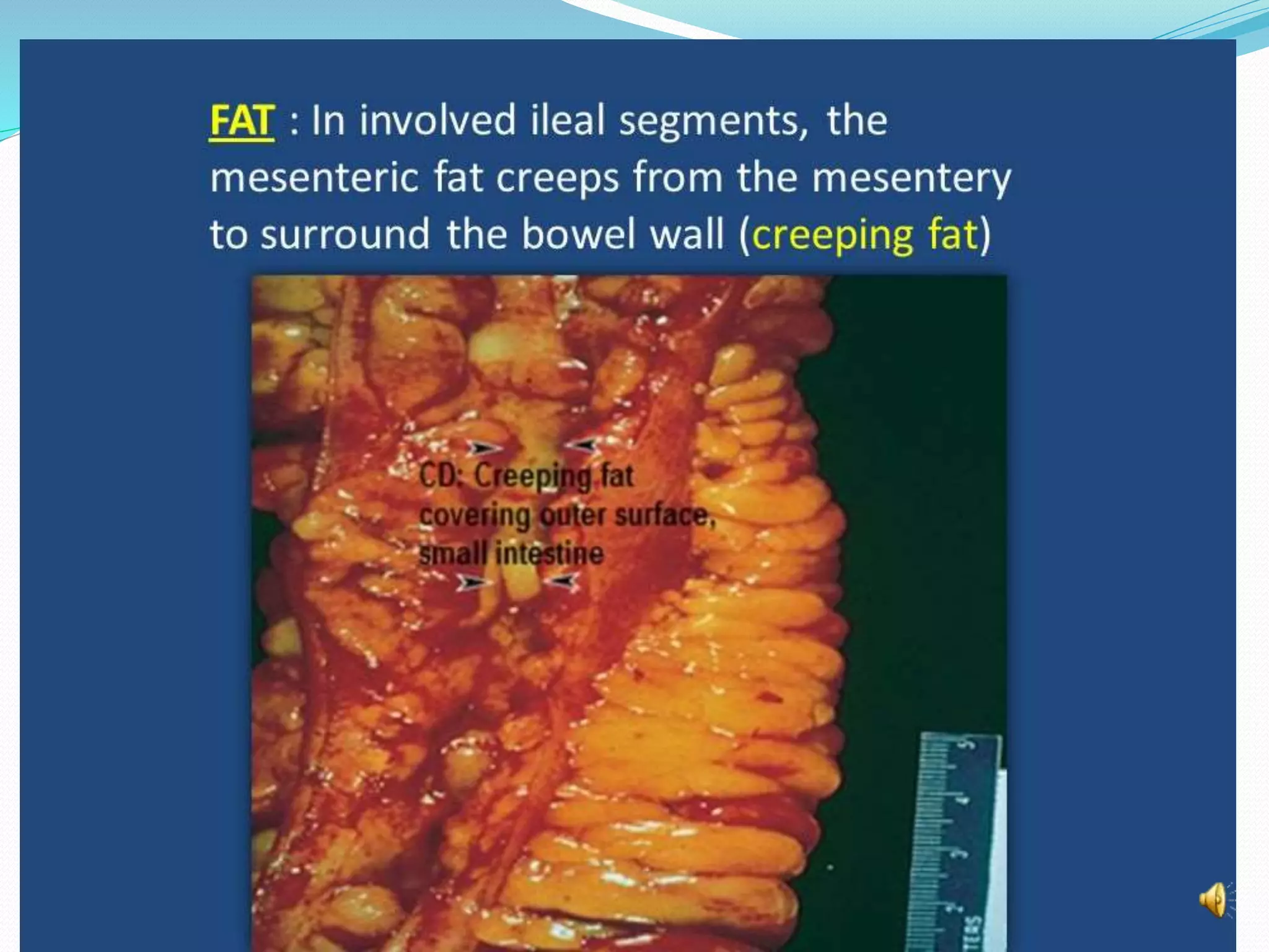 Ibd ulcerative colitis and crohn's disease | PPTX