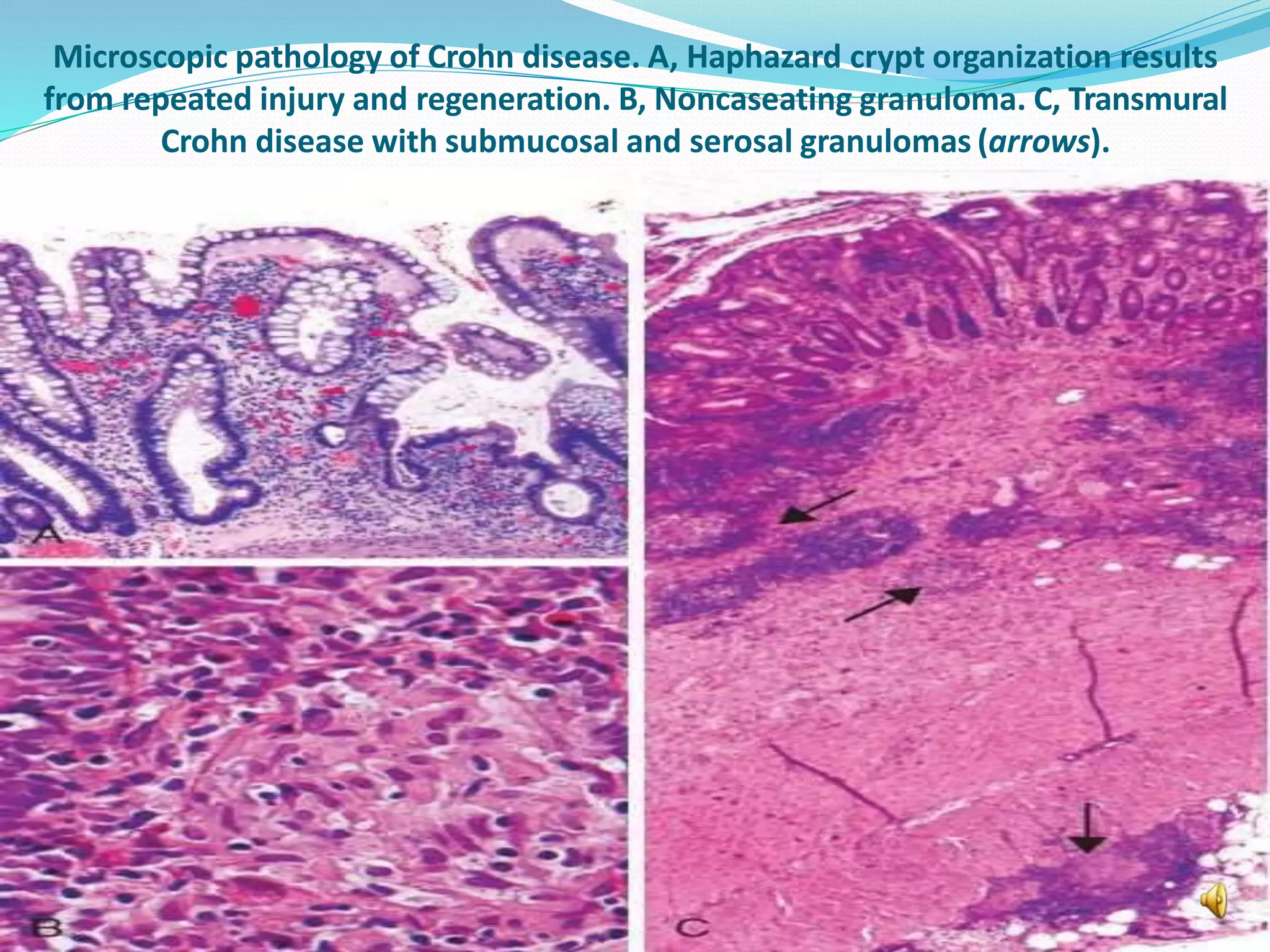 Ibd ulcerative colitis and crohn's disease | PPTX