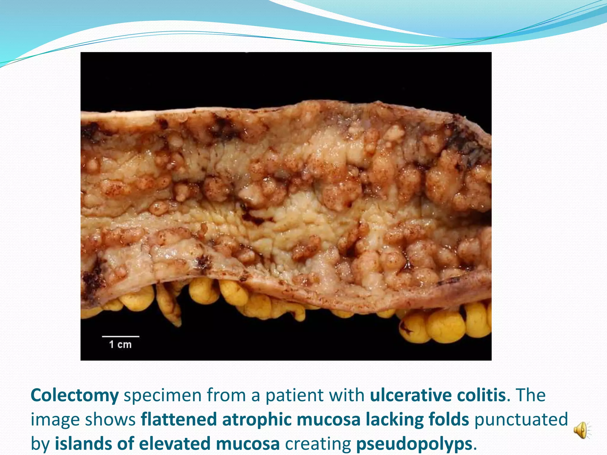 Ibd ulcerative colitis and crohn's disease | PPTX