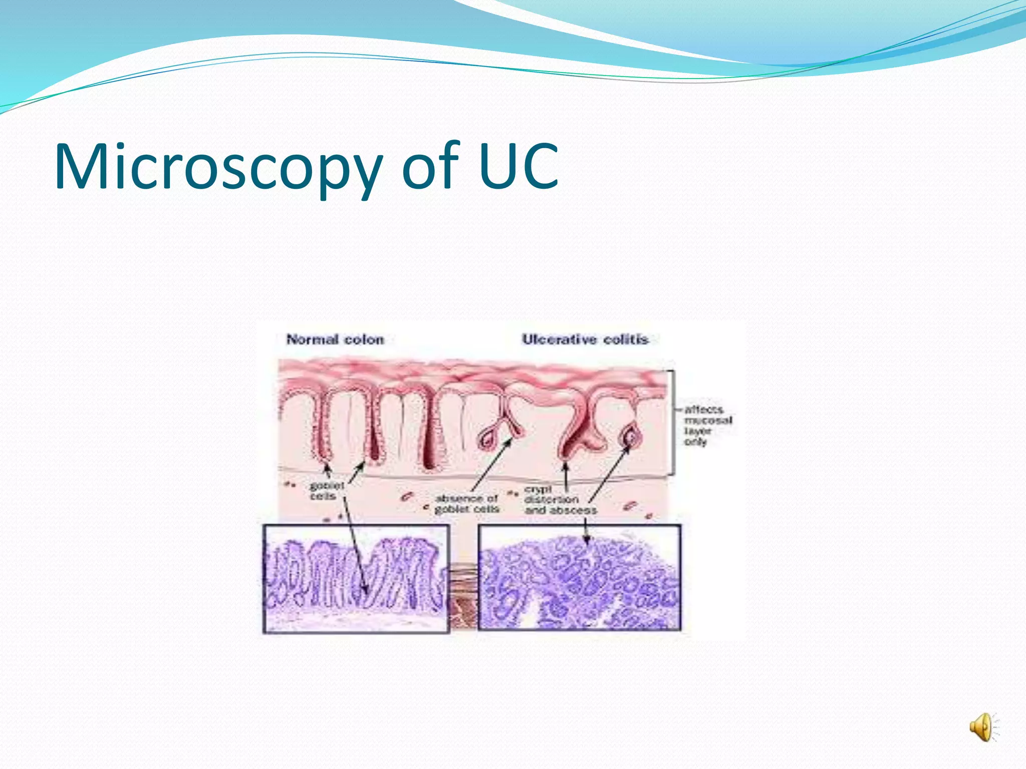 Ibd ulcerative colitis and crohn's disease | PPTX
