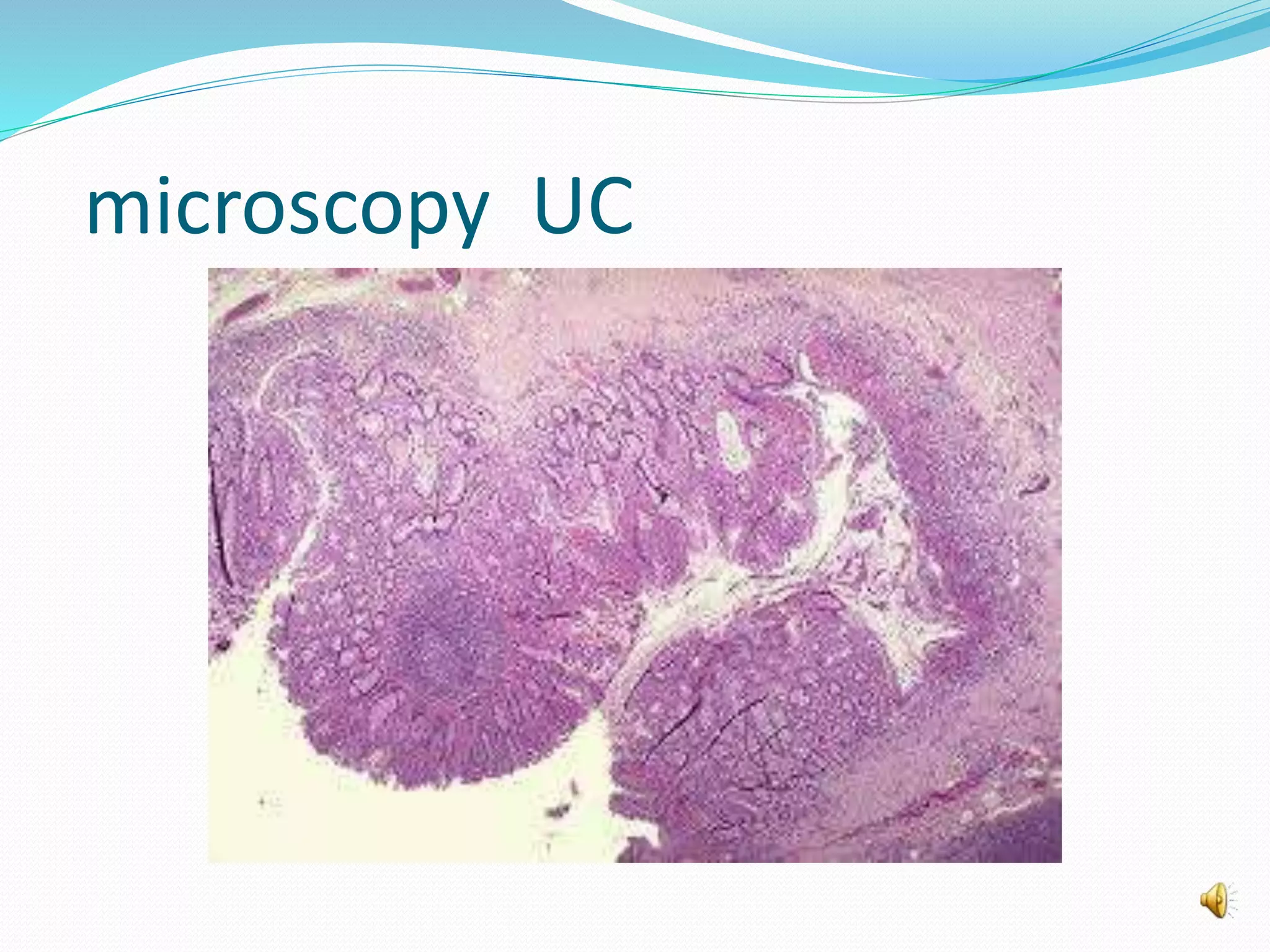 Ibd ulcerative colitis and crohn's disease | PPTX