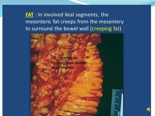 Ibd ulcerative colitis and crohn's disease | PPTX