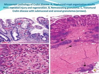 Ibd ulcerative colitis and crohn's disease | PPTX