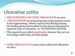 Ibd ulcerative colitis and crohn's disease | PPTX
