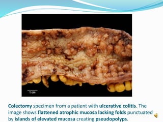 Ibd ulcerative colitis and crohn's disease | PPTX