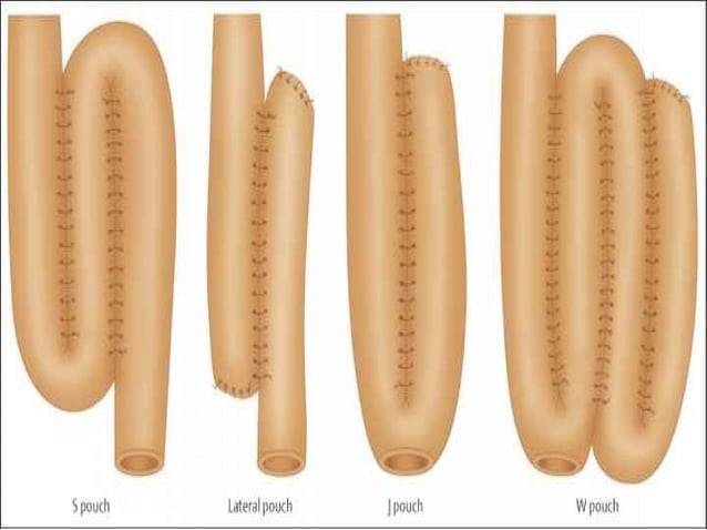 Inflammatory bowel disease IBD and management.pptx