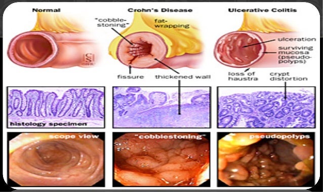 Inflammatory Bowel Diseases