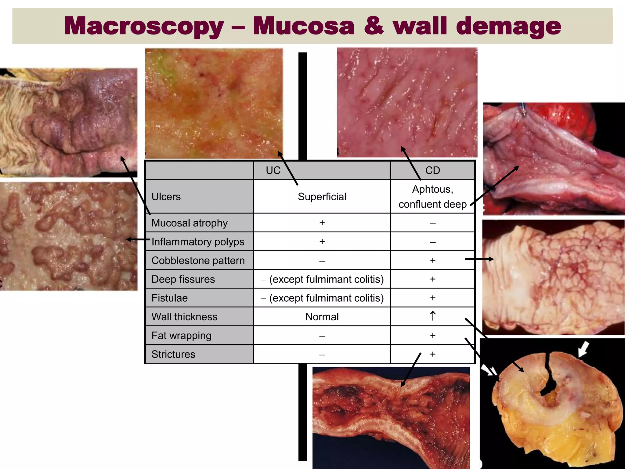 Inflammatory Bowel Disease (IBD) Histopathology | PPTX