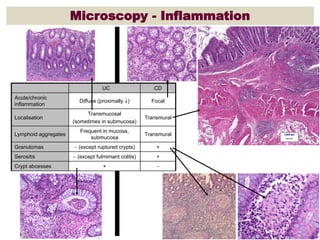 Inflammatory Bowel Disease (IBD) Histopathology | PPTX