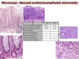 Inflammatory Bowel Disease (IBD) Histopathology | PPTX