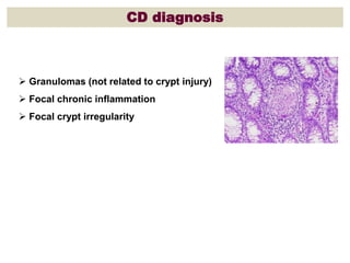 Inflammatory Bowel Disease (IBD) Histopathology | PPTX