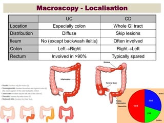 Inflammatory Bowel Disease (IBD) Histopathology | PPTX