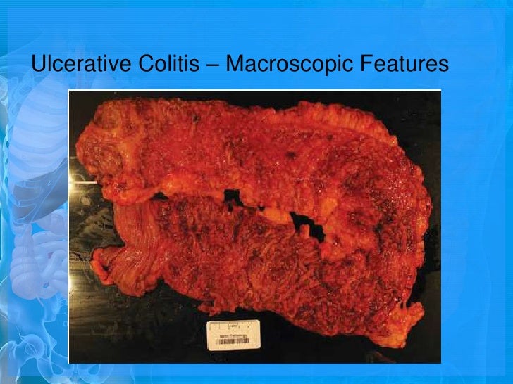 Inflammatory Bowel Disease, Irritable Bowel Syndrome