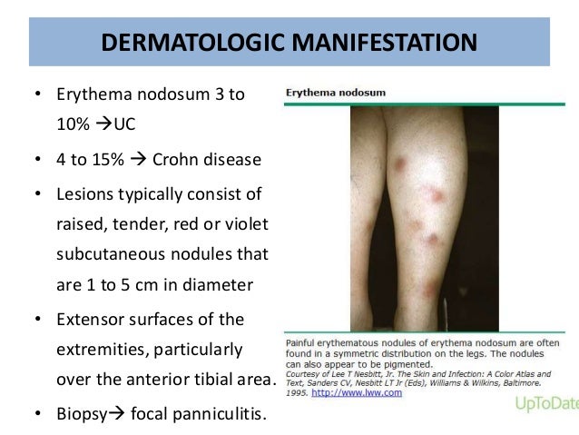 INFLAMMATORY BOWEL DISEASE ULCERATIVE COLITIS