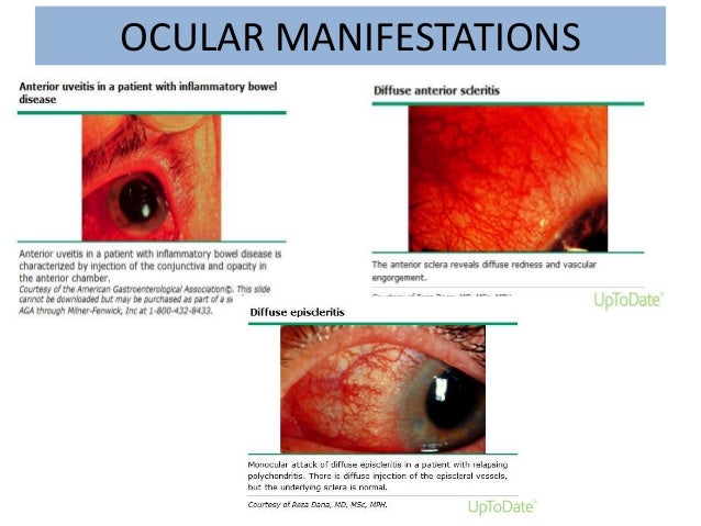 INFLAMMATORY BOWEL DISEASE ULCERATIVE COLITIS