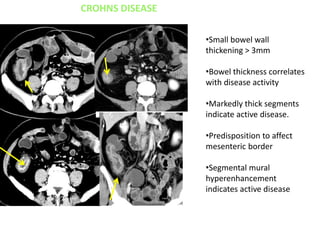 Inflammatory bowel disease | PPTX