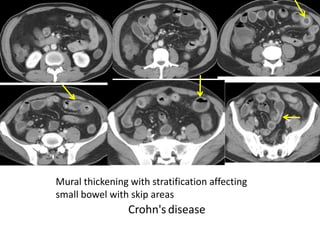 Inflammatory bowel disease | PPTX
