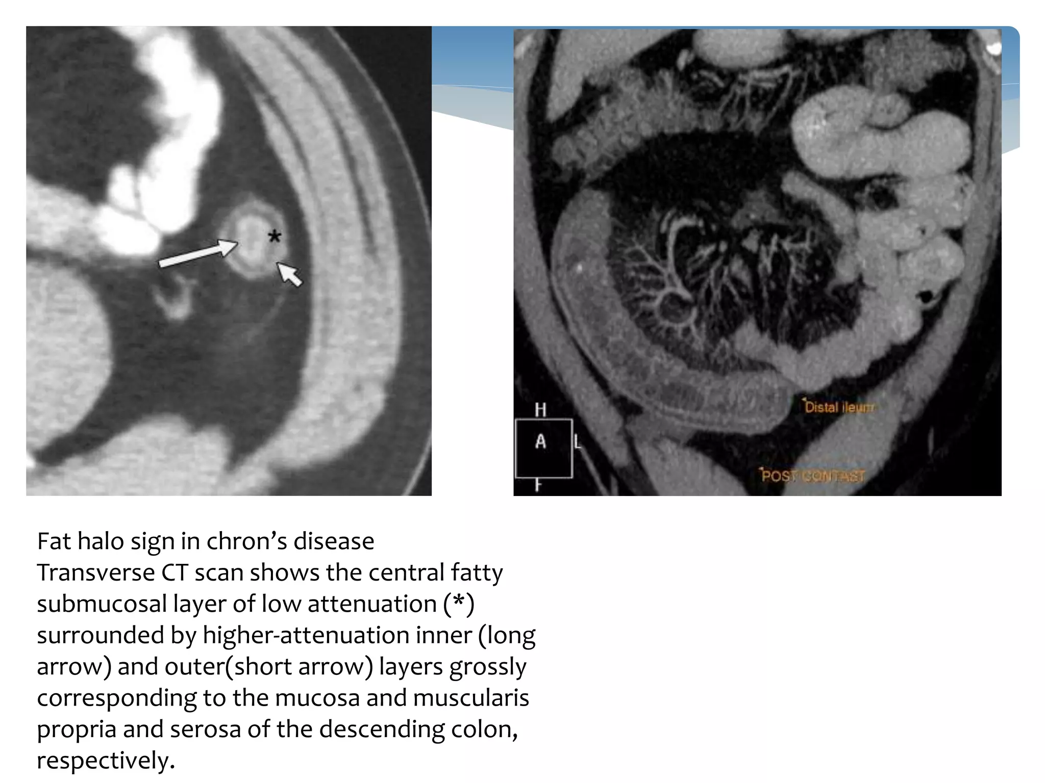 INFLAMMATORY BOWEL DISEASE IMAGING(RADIOLOGY) | PPTX
