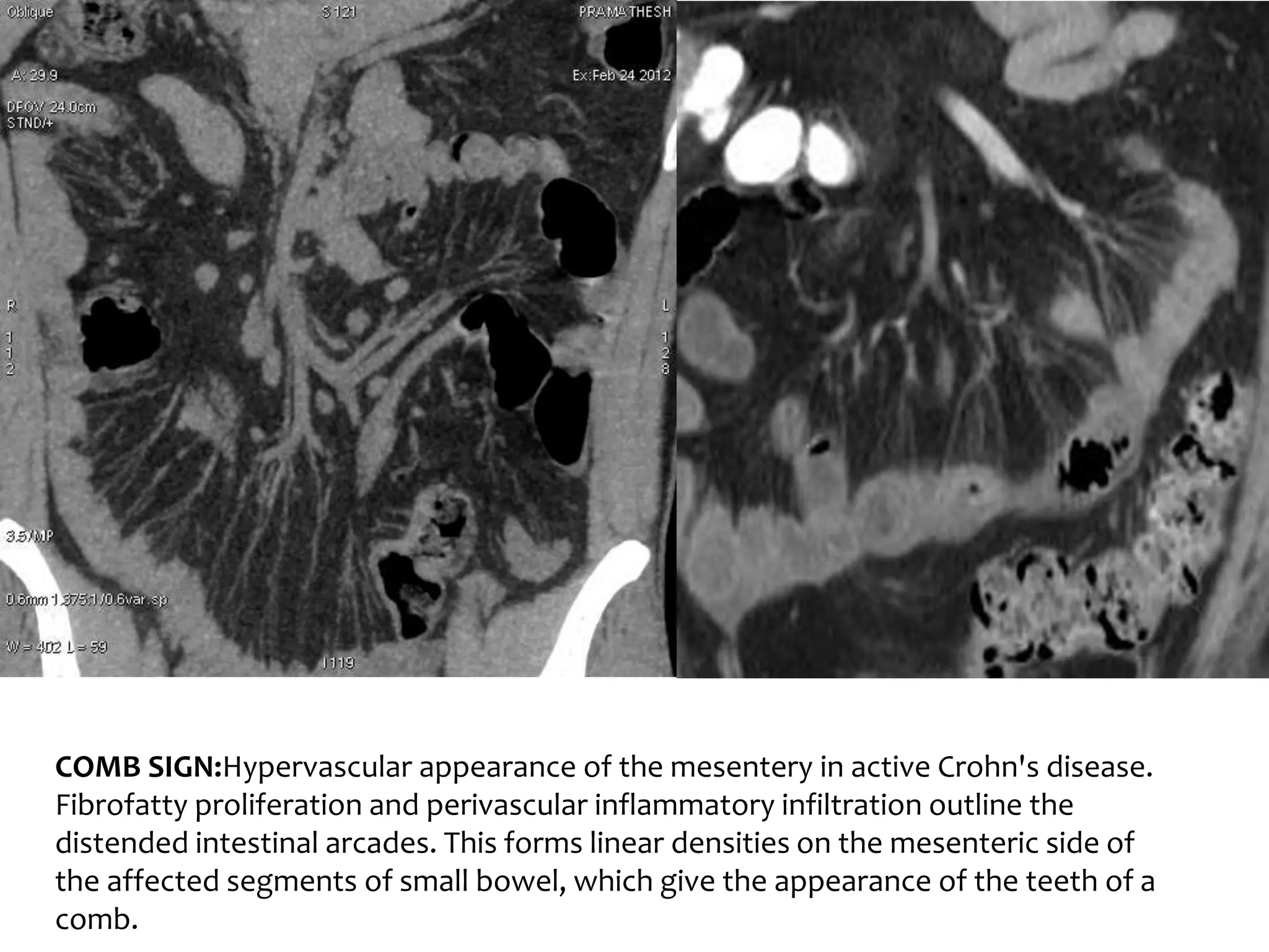 INFLAMMATORY BOWEL DISEASE IMAGING(RADIOLOGY) | PPTX