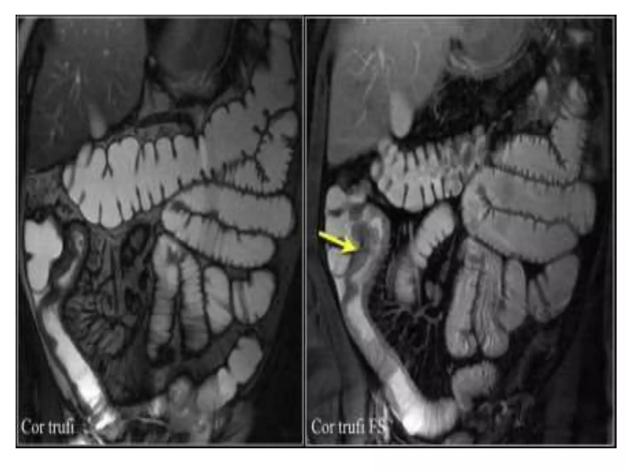 INFLAMMATORY BOWEL DISEASE IMAGING(RADIOLOGY) | PPT