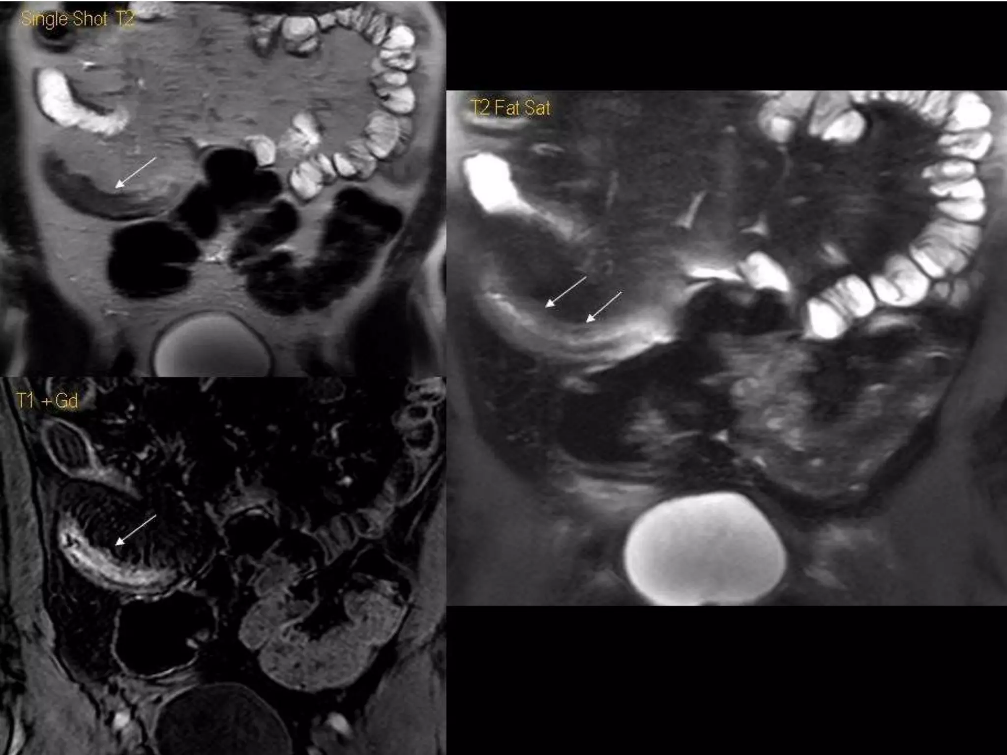 INFLAMMATORY BOWEL DISEASE IMAGING(RADIOLOGY) | PPTX