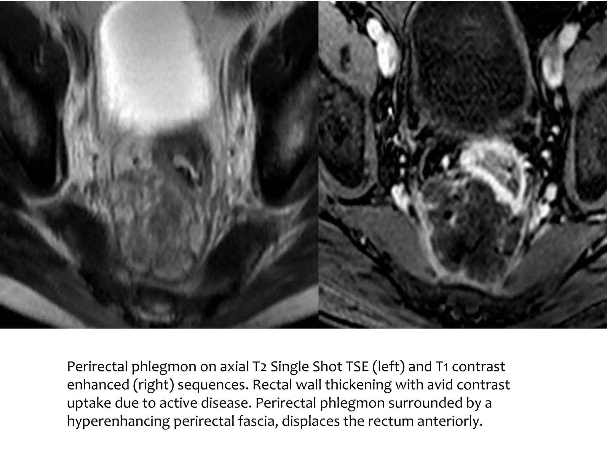 INFLAMMATORY BOWEL DISEASE IMAGING(RADIOLOGY) | PPTX