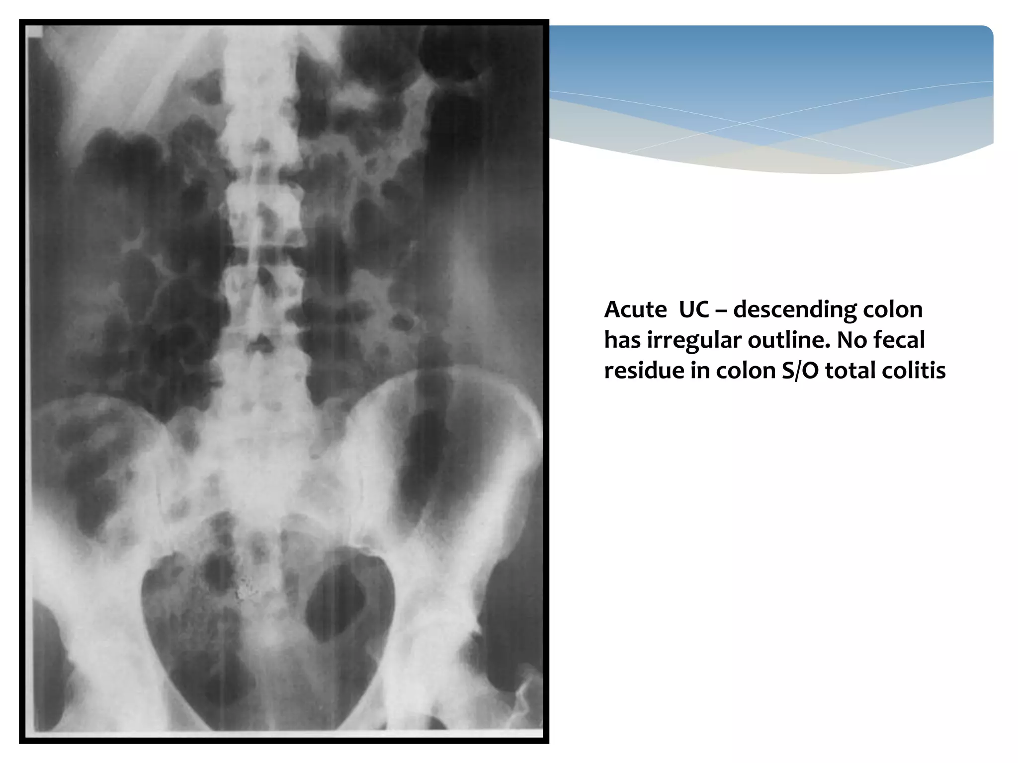 INFLAMMATORY BOWEL DISEASE IMAGING(RADIOLOGY) | PPTX