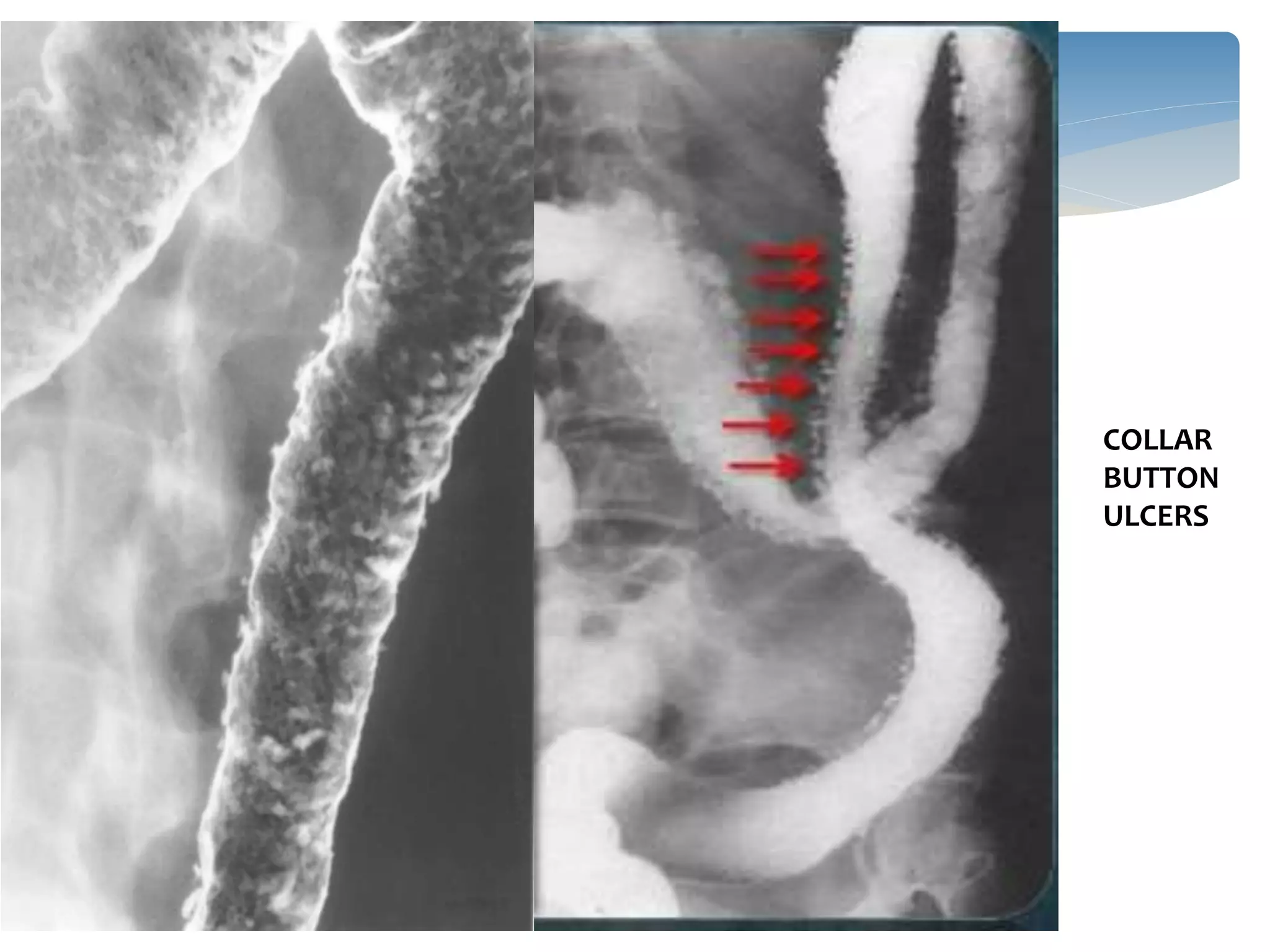 INFLAMMATORY BOWEL DISEASE IMAGING(RADIOLOGY) | PPTX