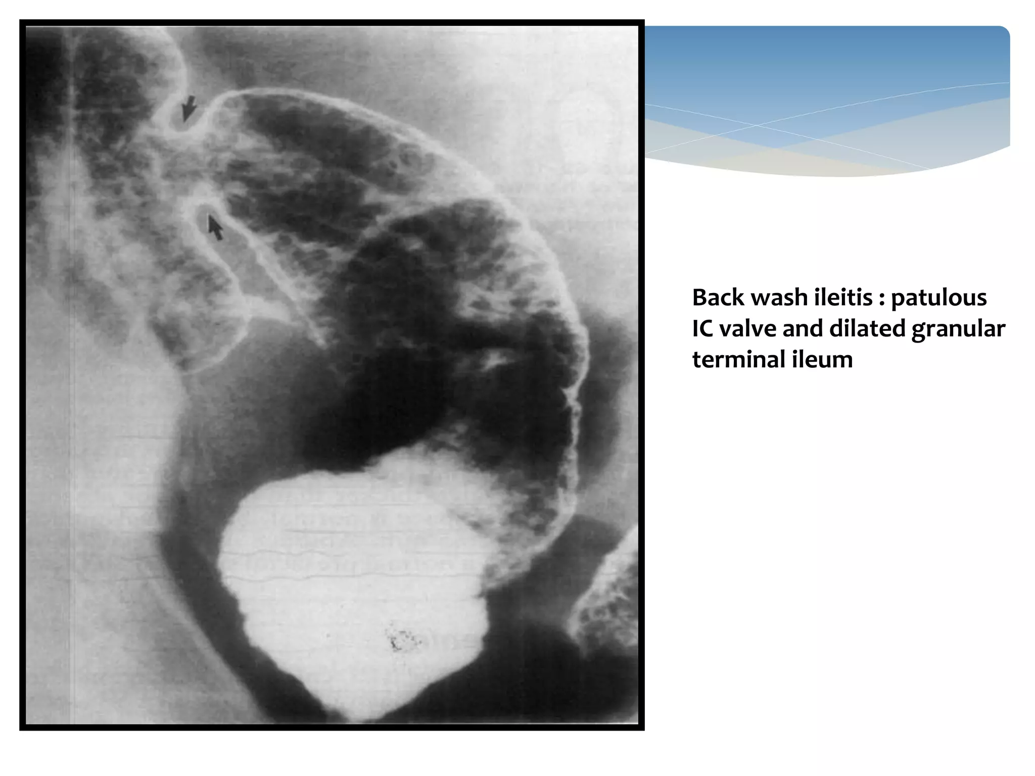 INFLAMMATORY BOWEL DISEASE IMAGING(RADIOLOGY) | PPTX