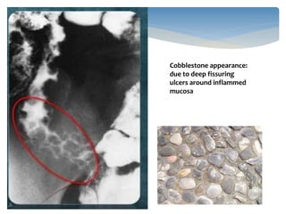 INFLAMMATORY BOWEL DISEASE IMAGING(RADIOLOGY) | PPTX