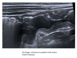 INFLAMMATORY BOWEL DISEASE IMAGING(RADIOLOGY) | PPTX